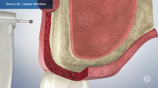 Sinus Lift Palo Alto CA | Upper Jaw Bone Graft