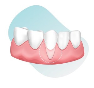 A Non-Surgical Solution for Receding Gums | Gum Builder™ in Palo Alto, CA